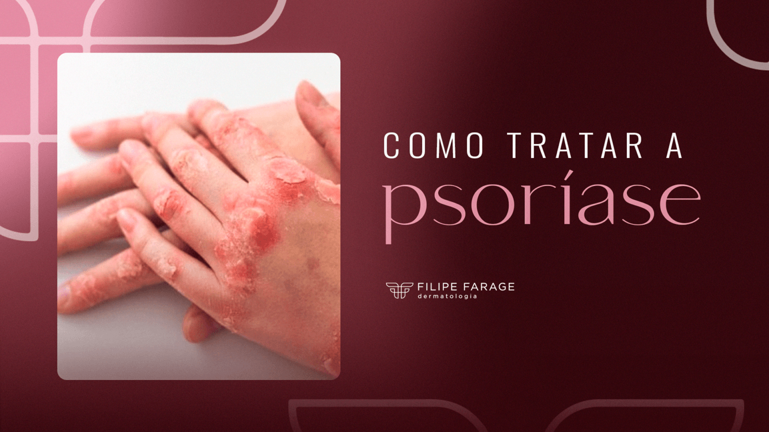 Como tratar a psoríase | Dr Filipe Farage