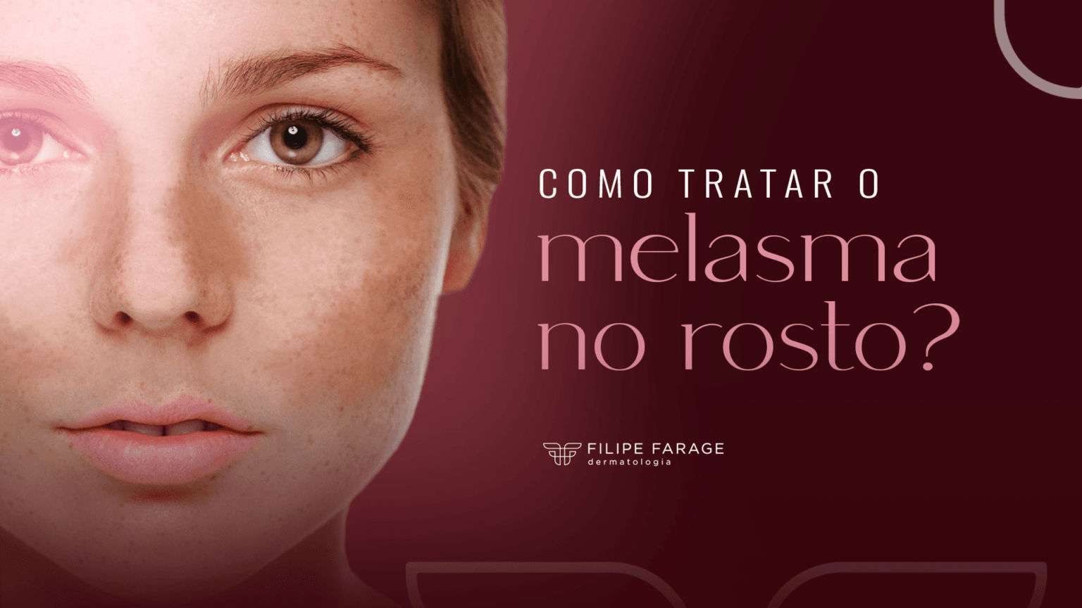 Como tratar o melasma no rosto - Dr. Filipe Farage