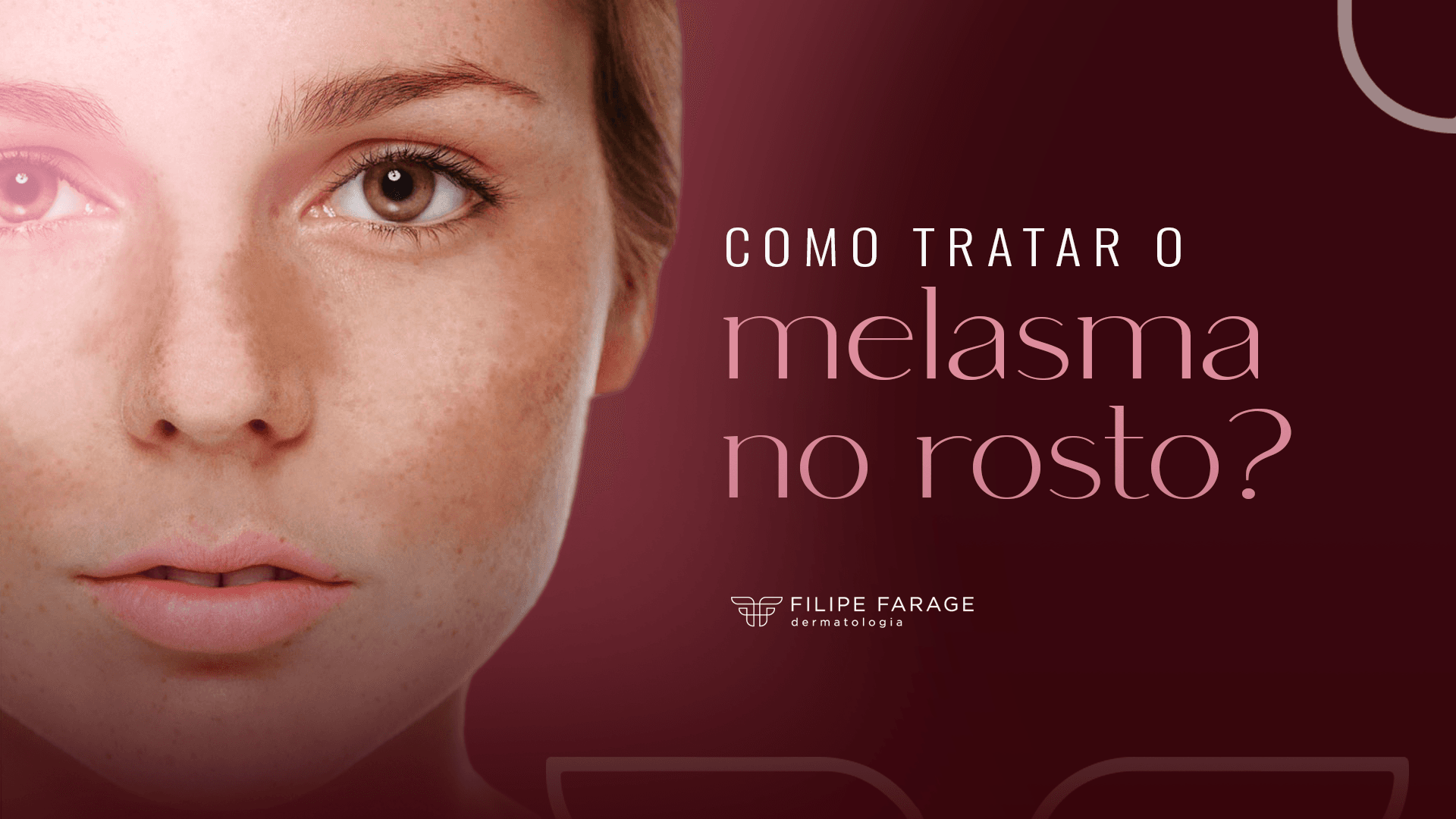 Como tratar o melasma no rosto - Dr. Filipe Farage