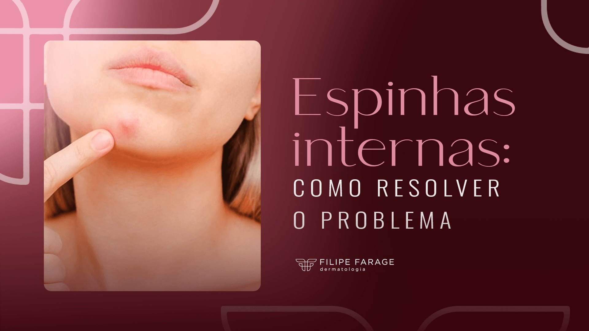 Espinhas internas: Como resolver o problema